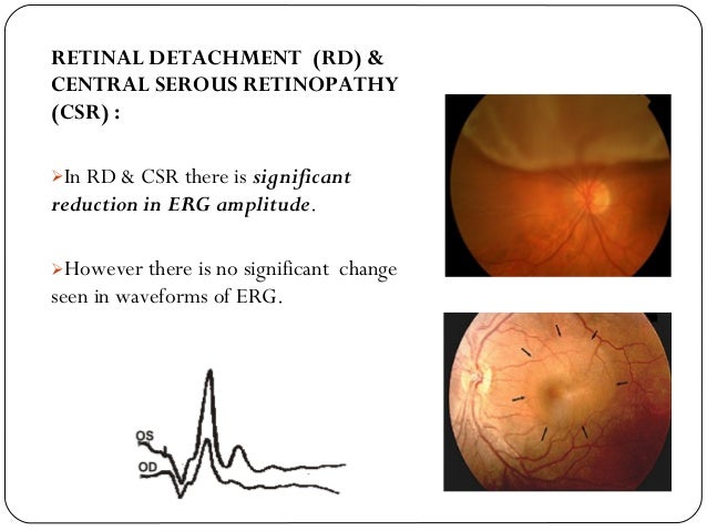 Electrophysiology in Ophthalmology