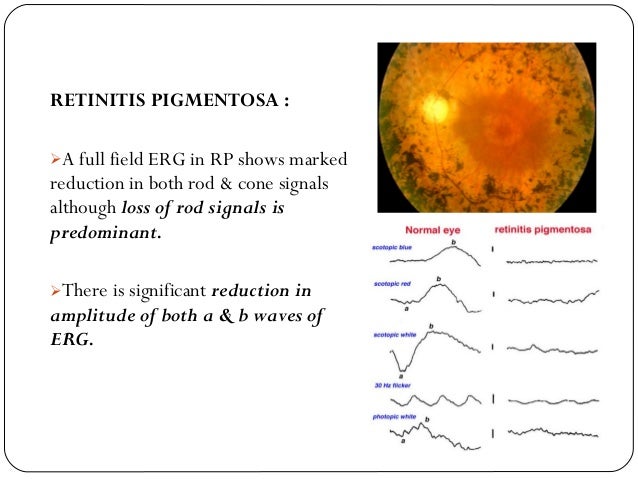 Electrophysiology in Ophthalmology