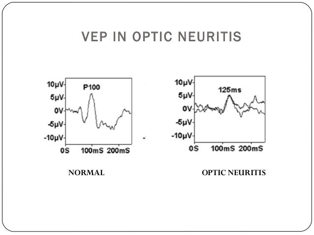 Electrophysiology in Ophthalmology