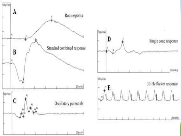 Electroretinogram (erg) | PPTX | Eye and Vision Conditions | Diseases ...