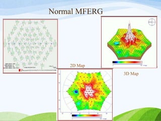 Electroretinogram (erg) | PPTX