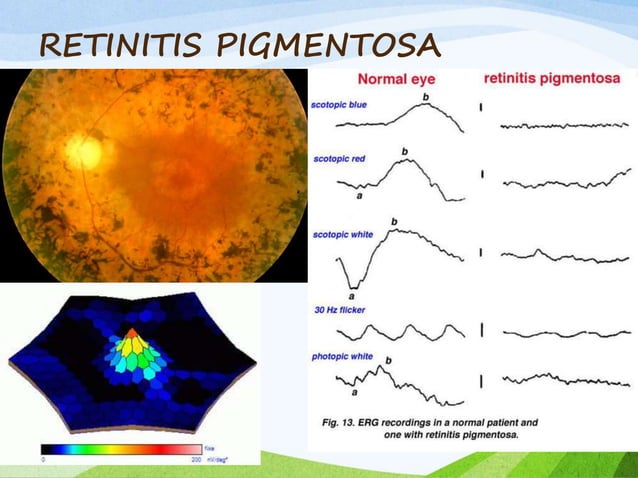 Electroretinogram (erg) | PPTX | Eye and Vision Conditions | Diseases ...