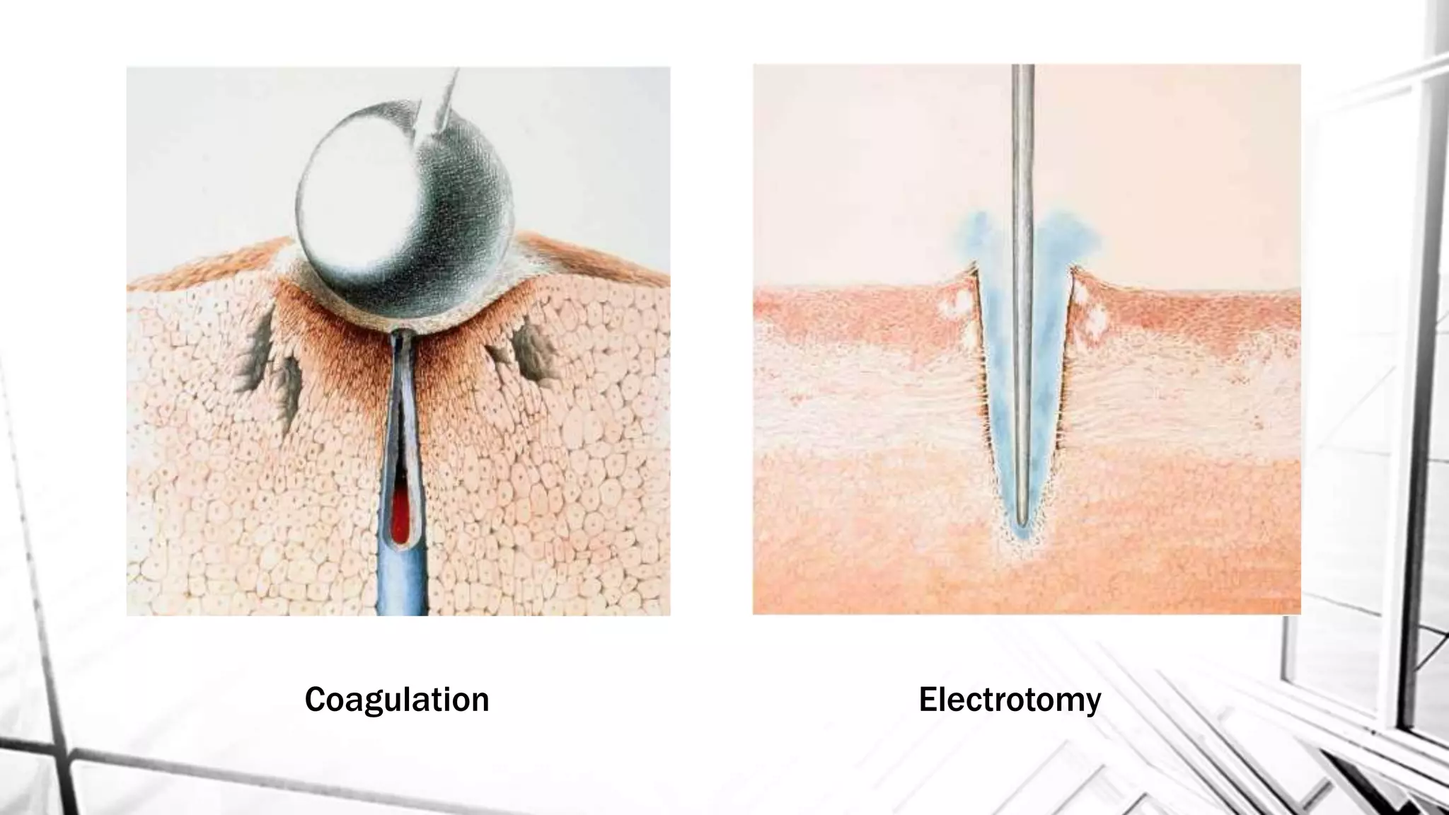 Electrosurgery | PPTX