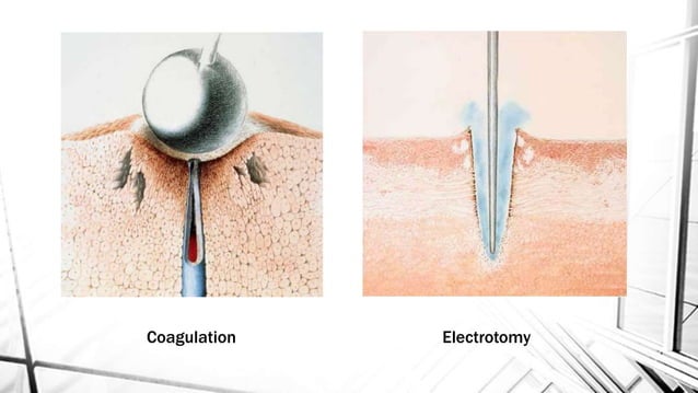 Electrosurgery | PPTX