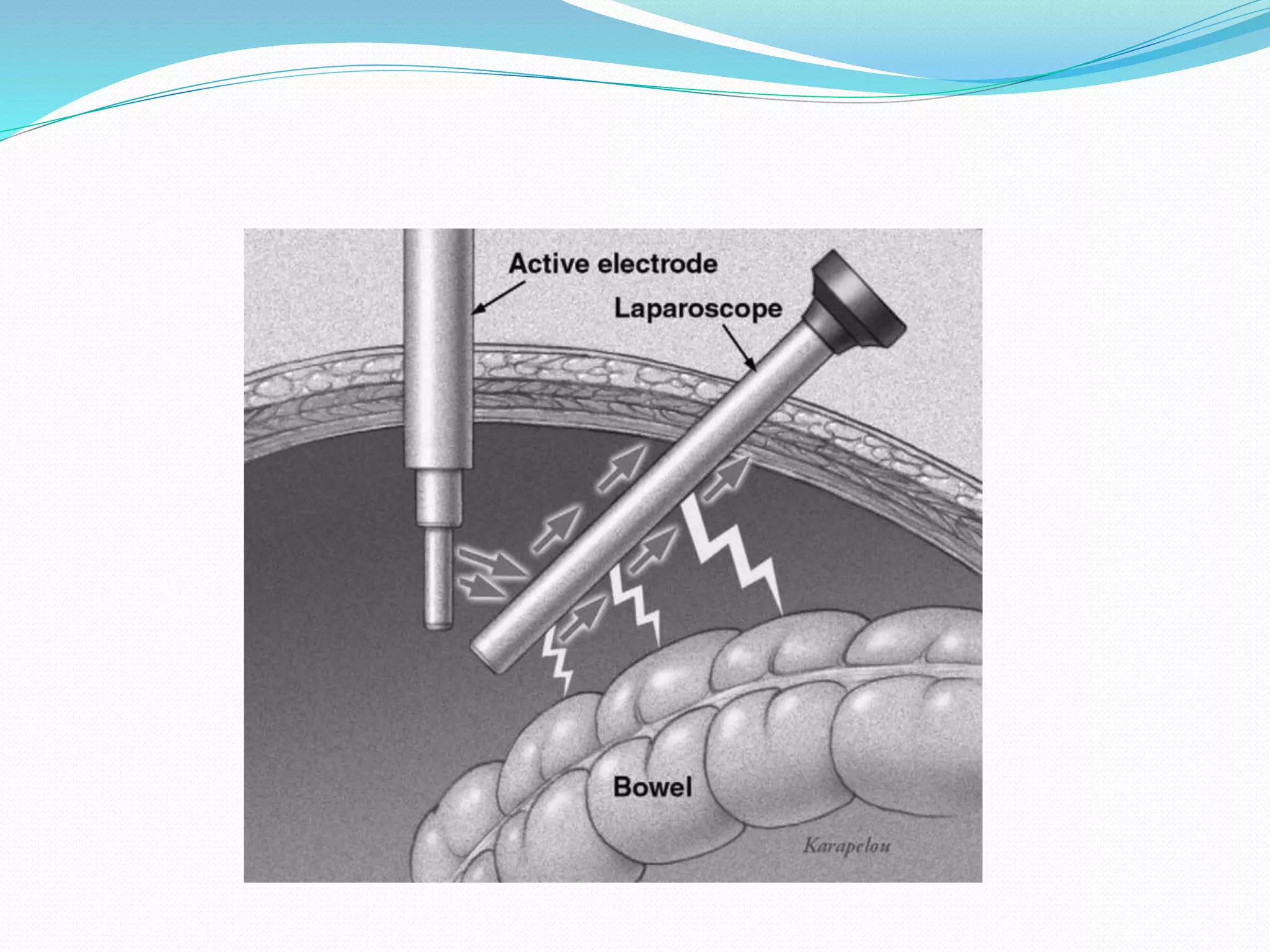 Electrosurgery | PPTX