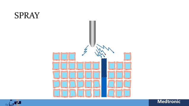 Electrosurgery | PPSX