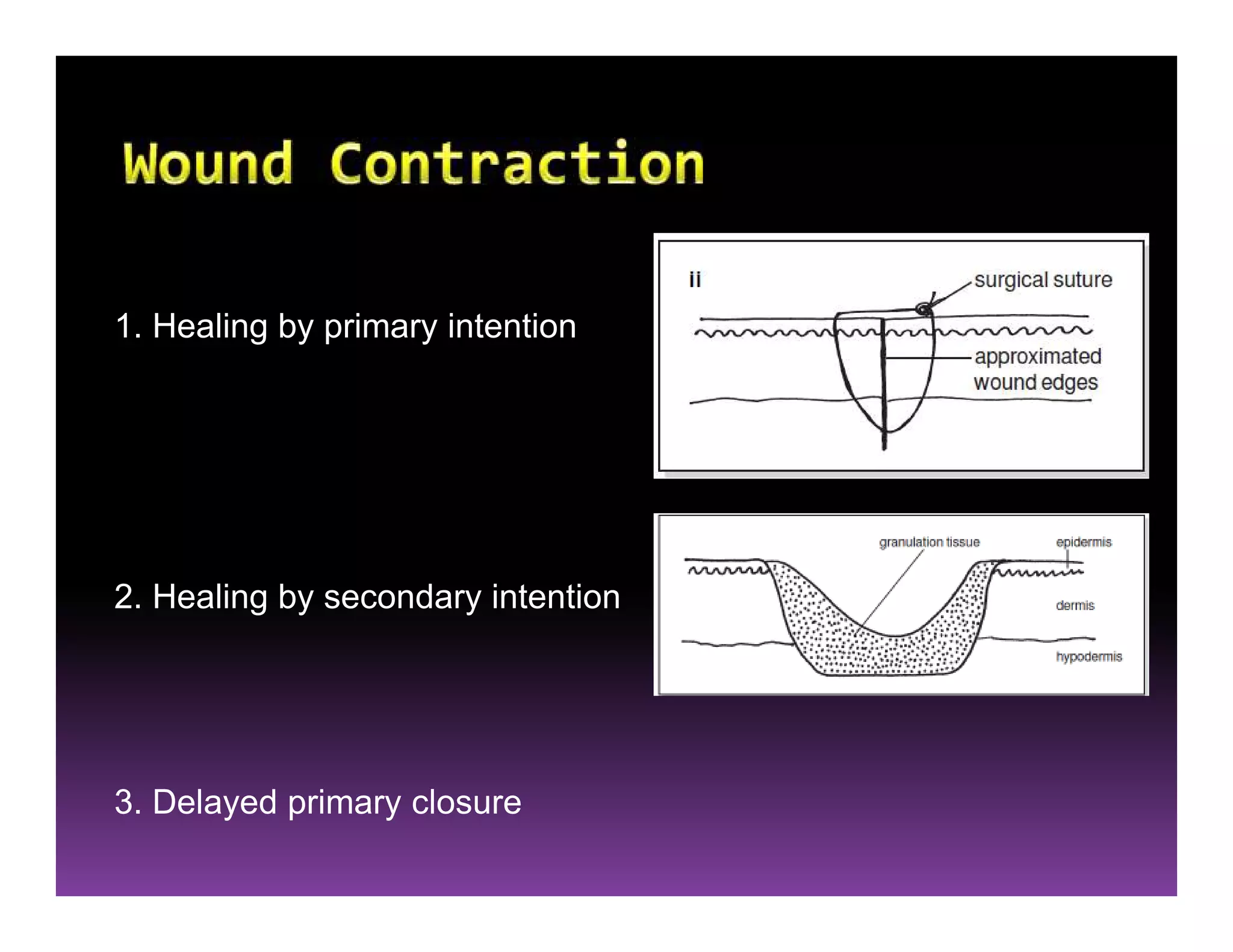 Electrotherapy in wound healing | PDF