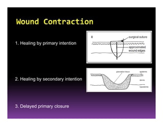 Electrotherapy in wound healing | PDF