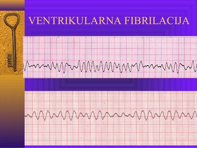 Elektricna defibrilacija 9