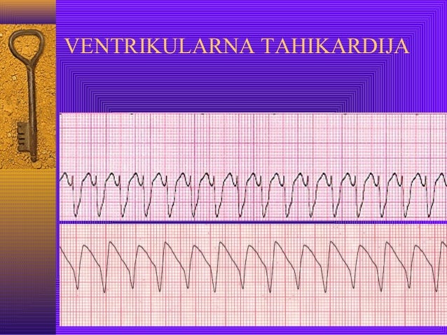 Elektricna defibrilacija 9