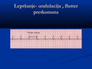 Električna defibrilacija i kardioverzija | PPT