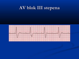 Električna defibrilacija i kardioverzija | PPT