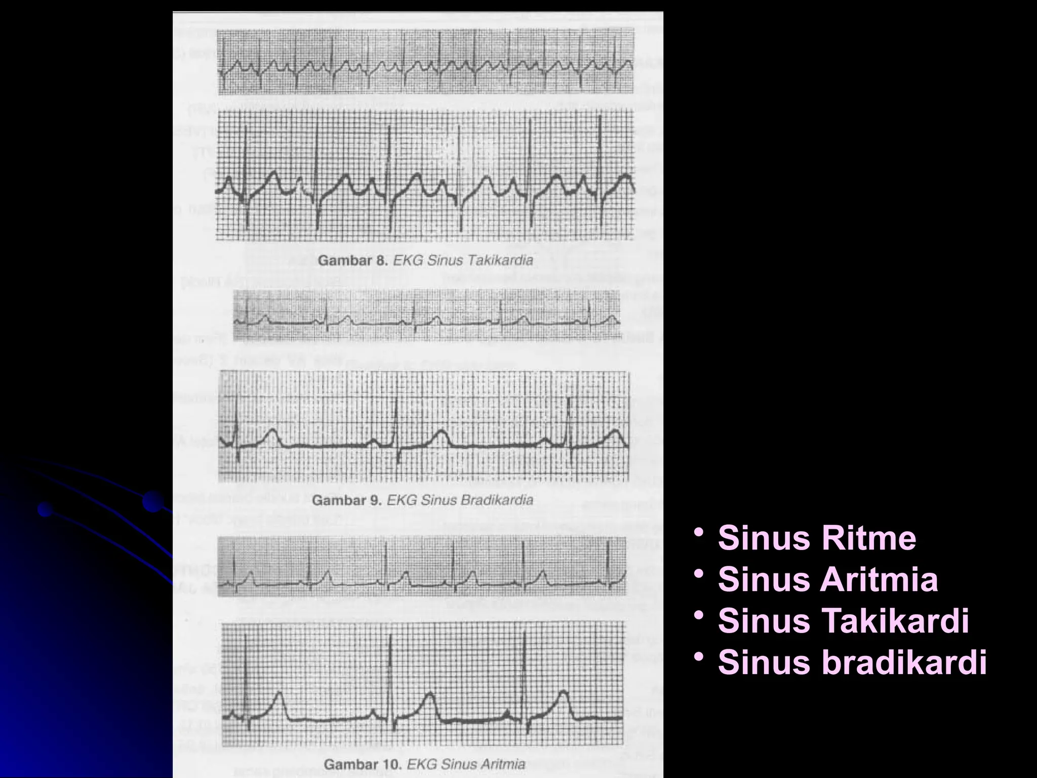 Elektrofisiologi Jantung dan Aritmia.pptx