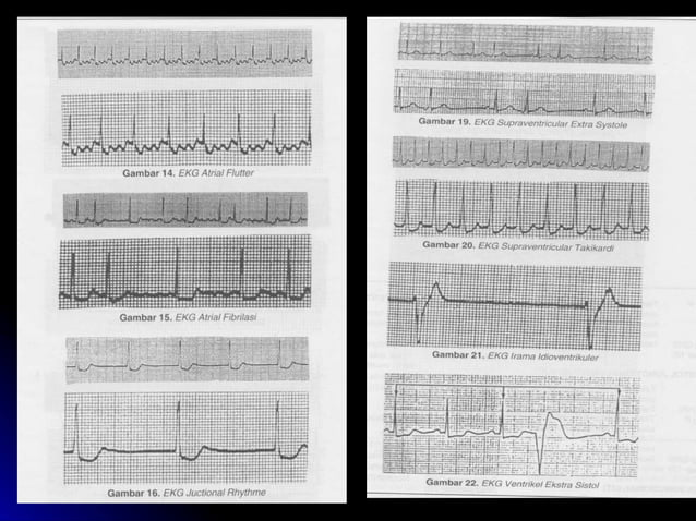 Elektrofisiologi Jantung dan Aritmia.pptx