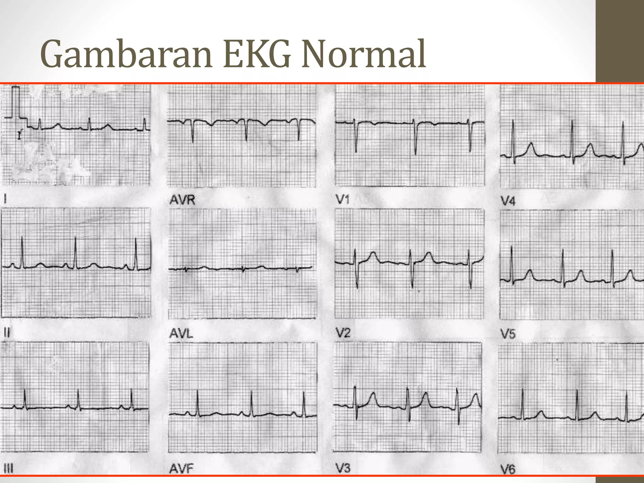 ELEKTROKARDIOGRAFI.pptx