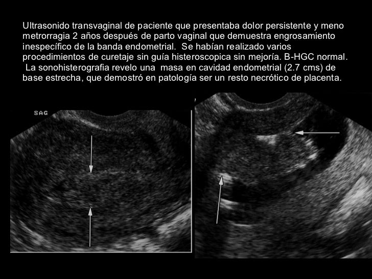 Patología endometrial