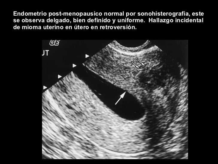 Patología endometrial
