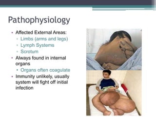 Elephantiasis | PPTX