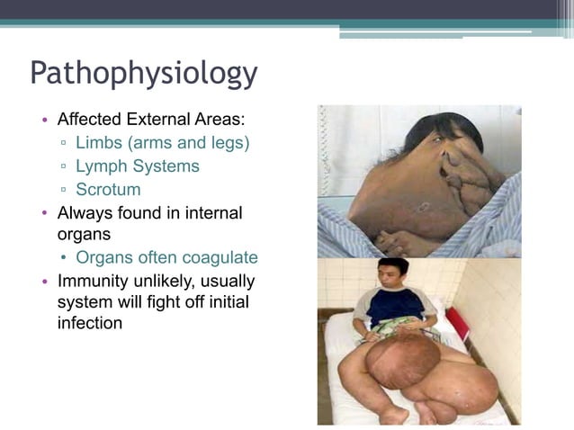 Elephantiasis | PPTX