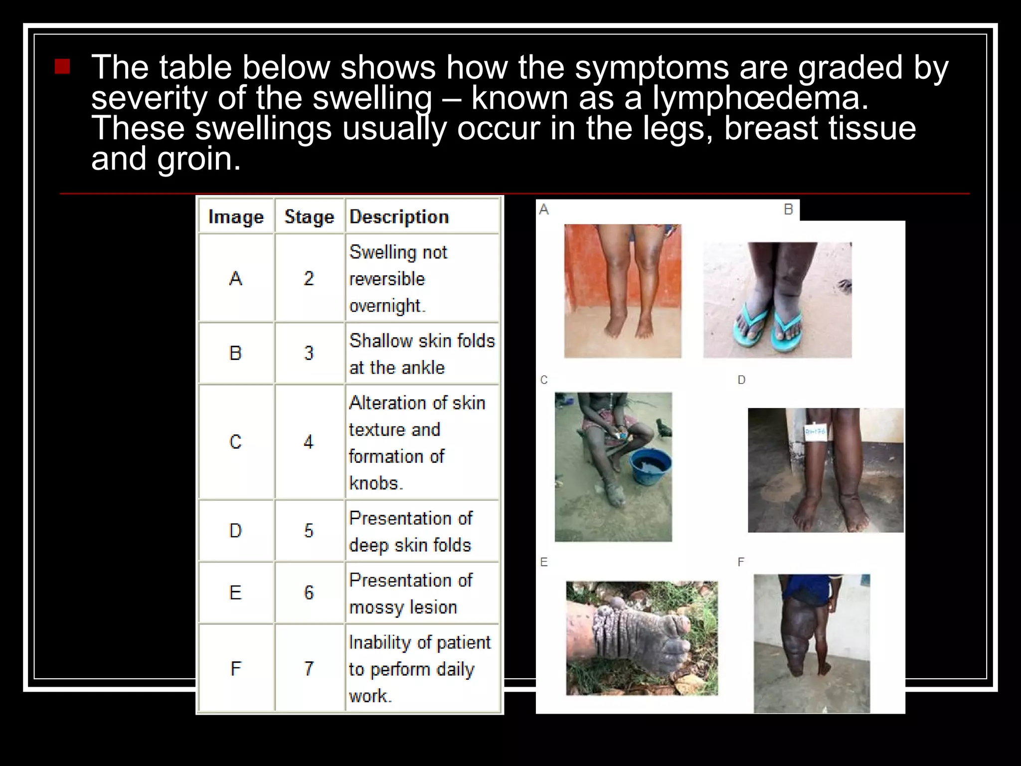 elephantiasisppt2783.pdf