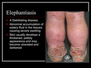 elephantiasisppt2783.pdf