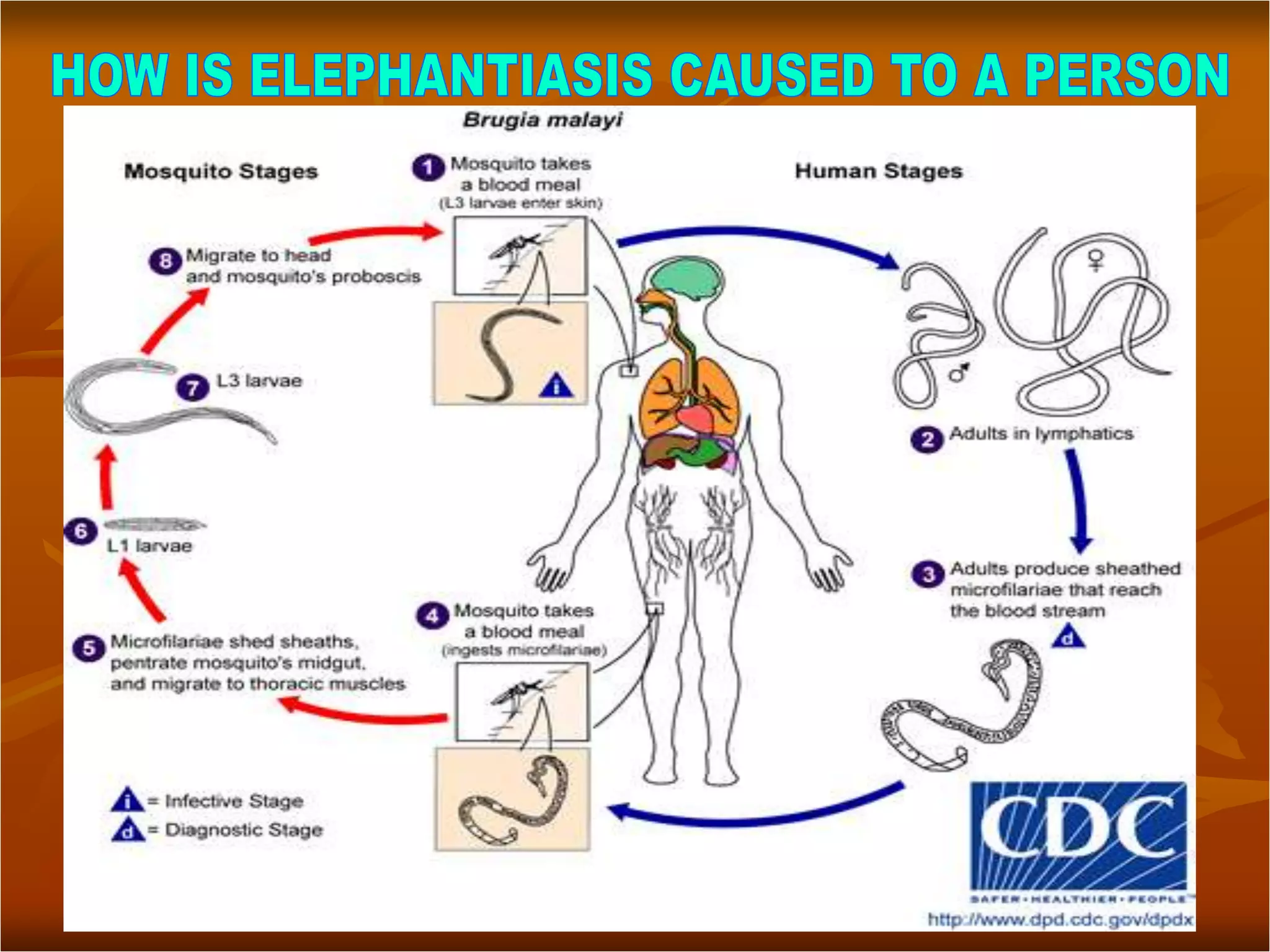 Elephantiasis presentation1 | PPSX