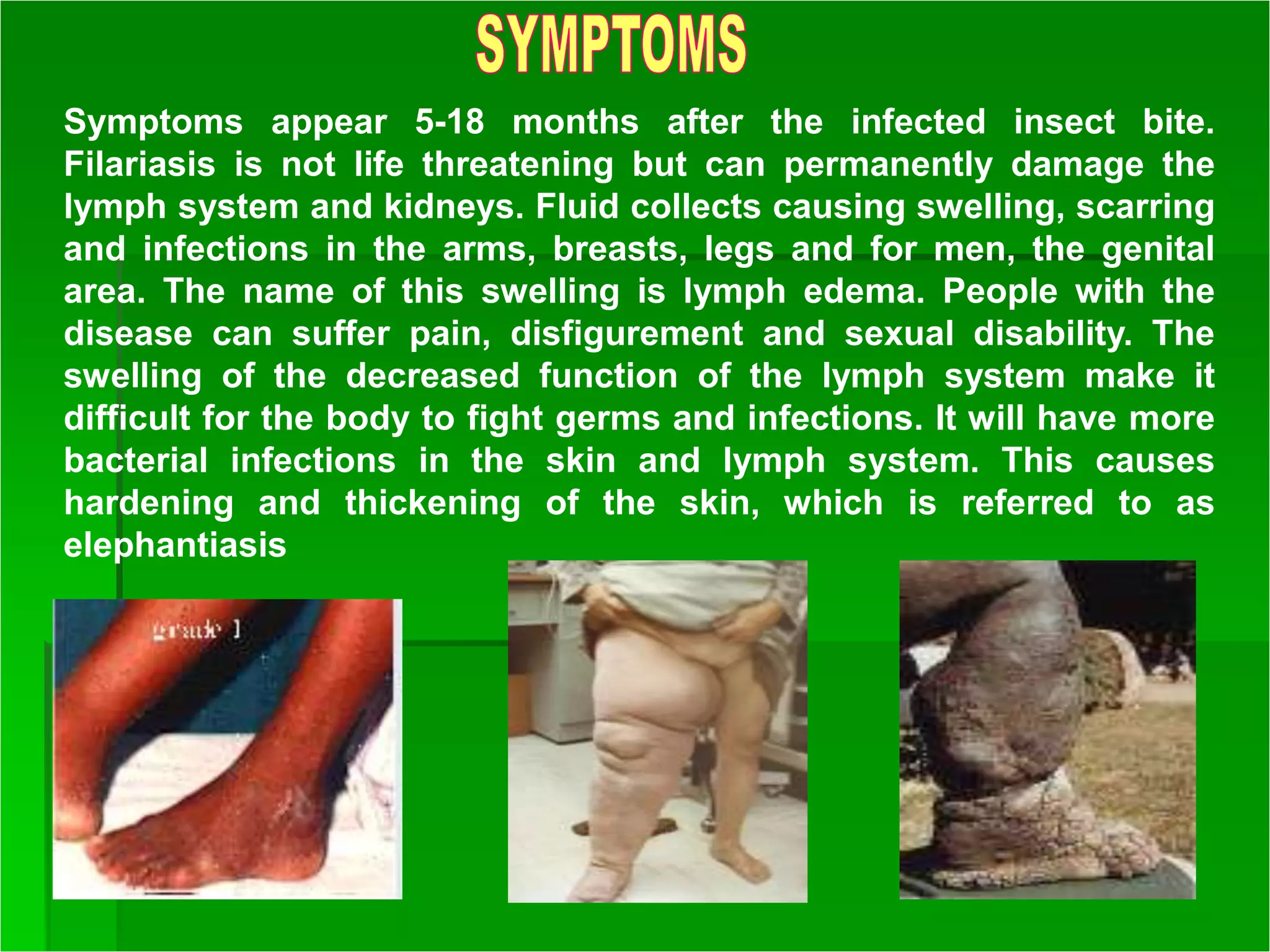 Elephantiasis presentation1 | PPSX