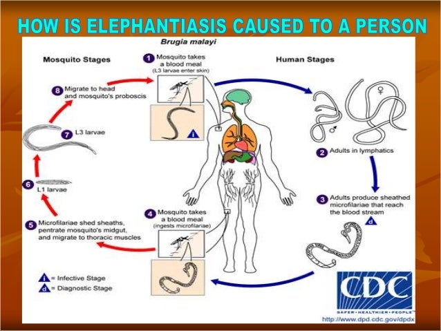 Elephantiasis presentation1