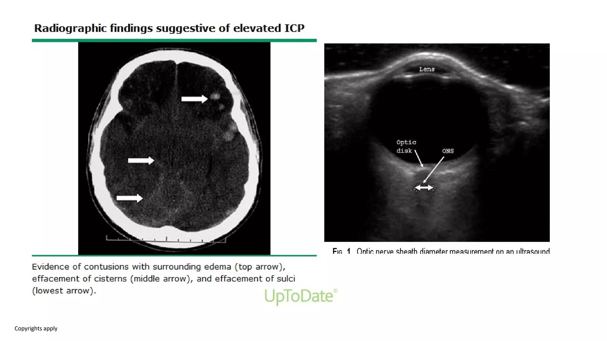Elevated intracranial pressure (icp) in children | PPT