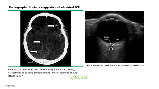 Elevated intracranial pressure (icp) in children | PPT