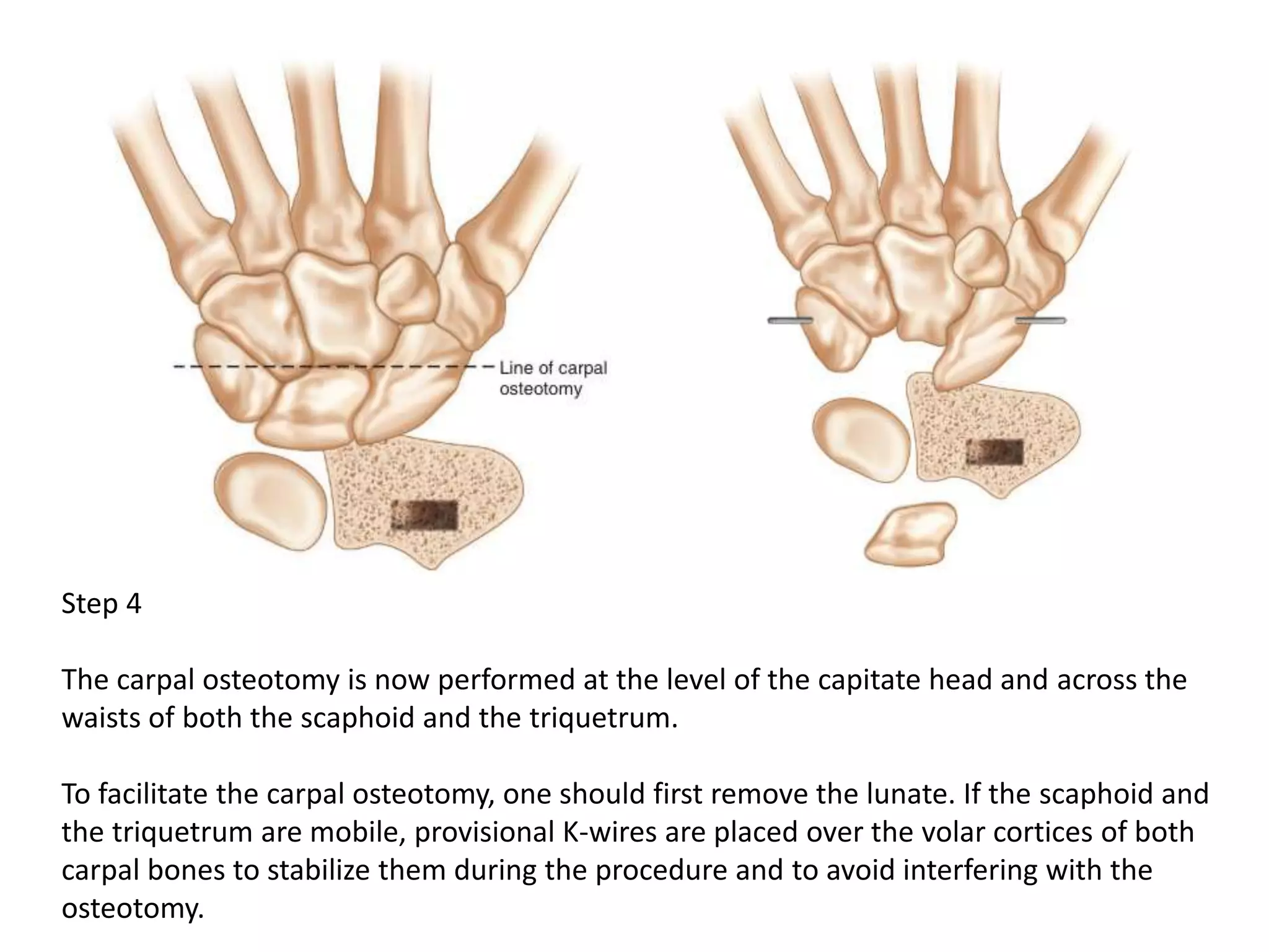 Wrist arthroplasty | PPTX