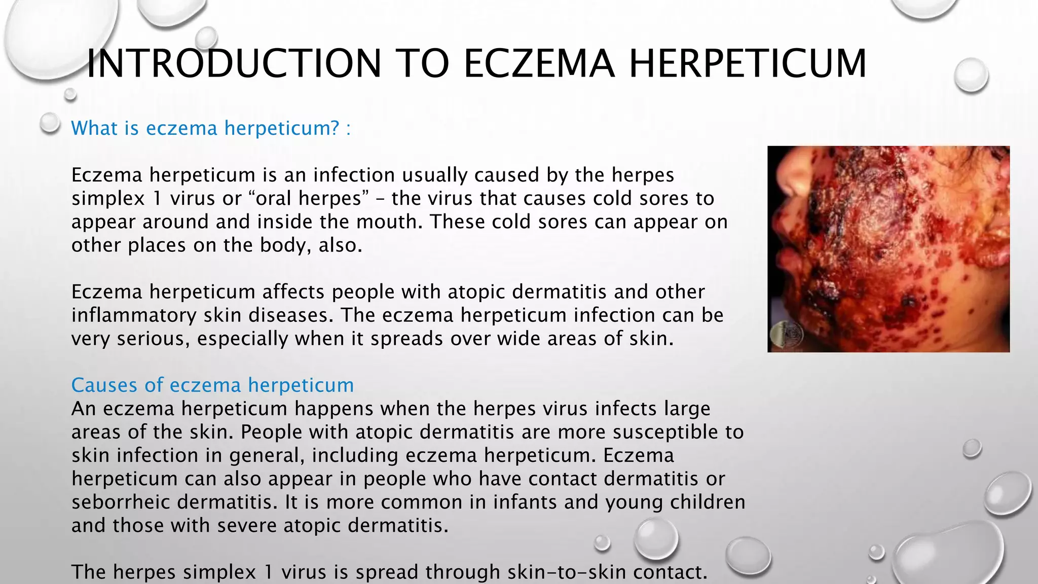 ECZEMA - dermatology case presentation | PPTX