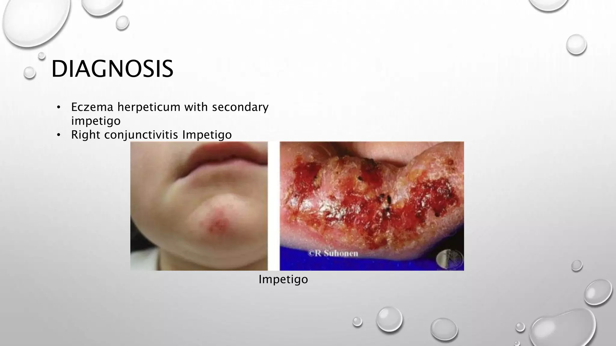 ECZEMA - dermatology case presentation | PPTX