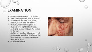 ECZEMA - dermatology case presentation | PPTX