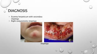 ECZEMA - dermatology case presentation | PPTX
