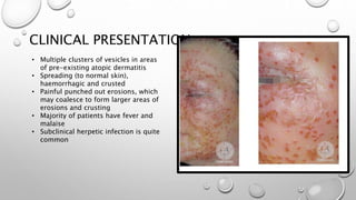 ECZEMA - dermatology case presentation | PPTX