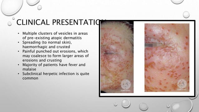 ECZEMA - dermatology case presentation | PPTX | Infectious Diseases ...