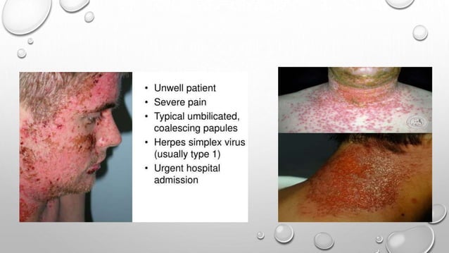 ECZEMA - dermatology case presentation | PPTX | Infectious Diseases | Diseases and Conditions