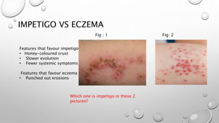 ECZEMA - dermatology case presentation | PPT