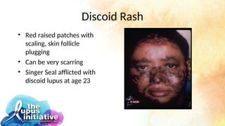 ELHDI-Lupus-disease-Overview-ENG-2021.ppt