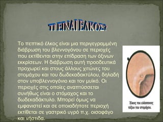 Πεπτικό έλκος | PPT