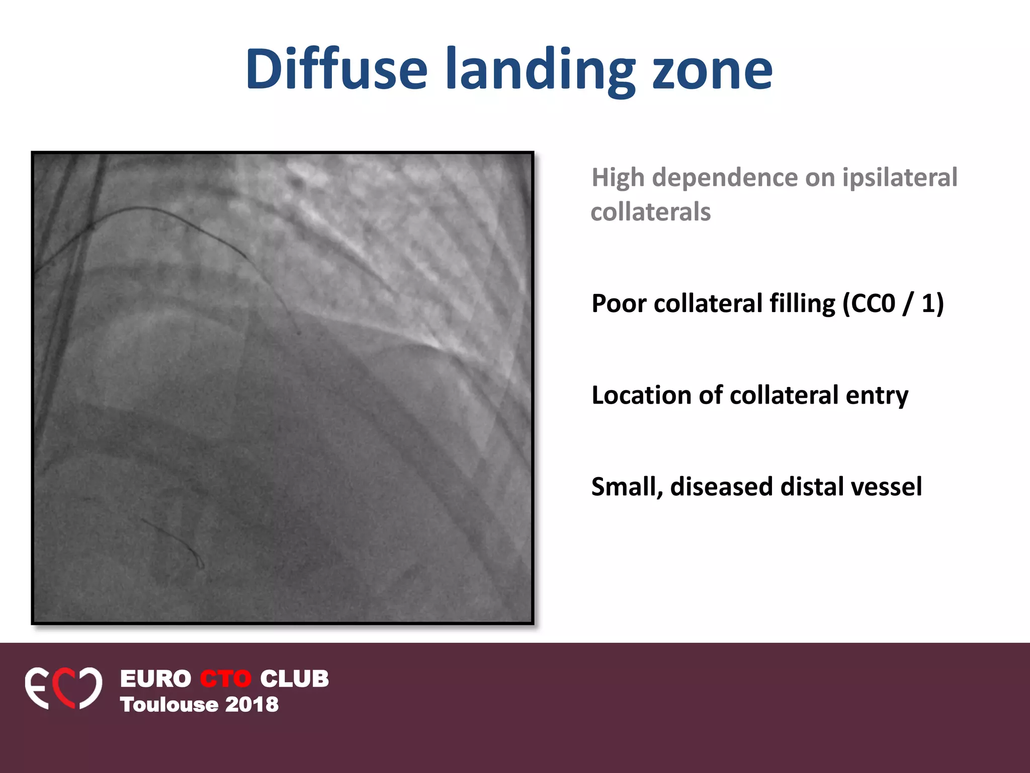Antegrade dissection and haematoma | PPT