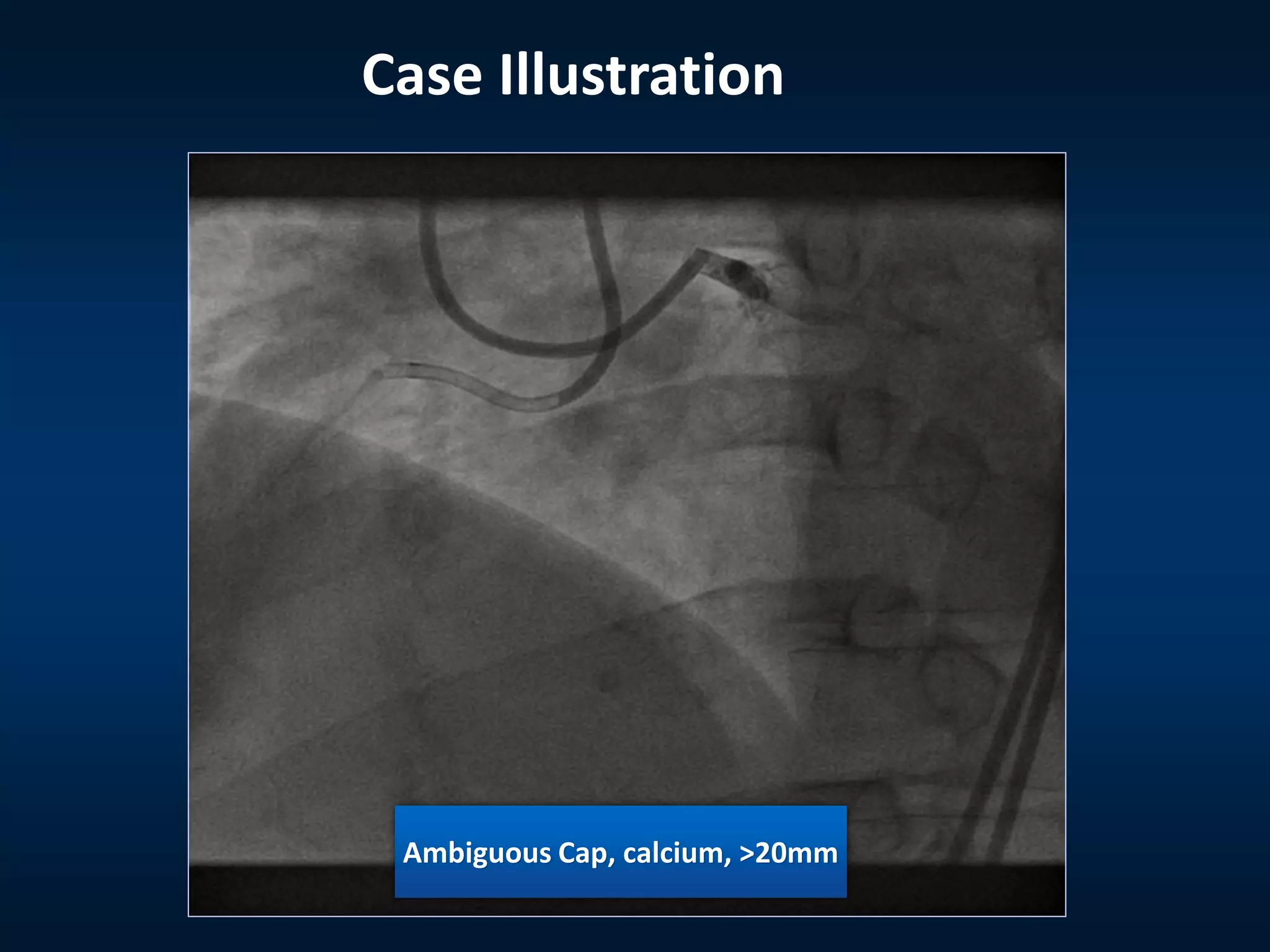 Antegrade dissection and haematoma | PPT
