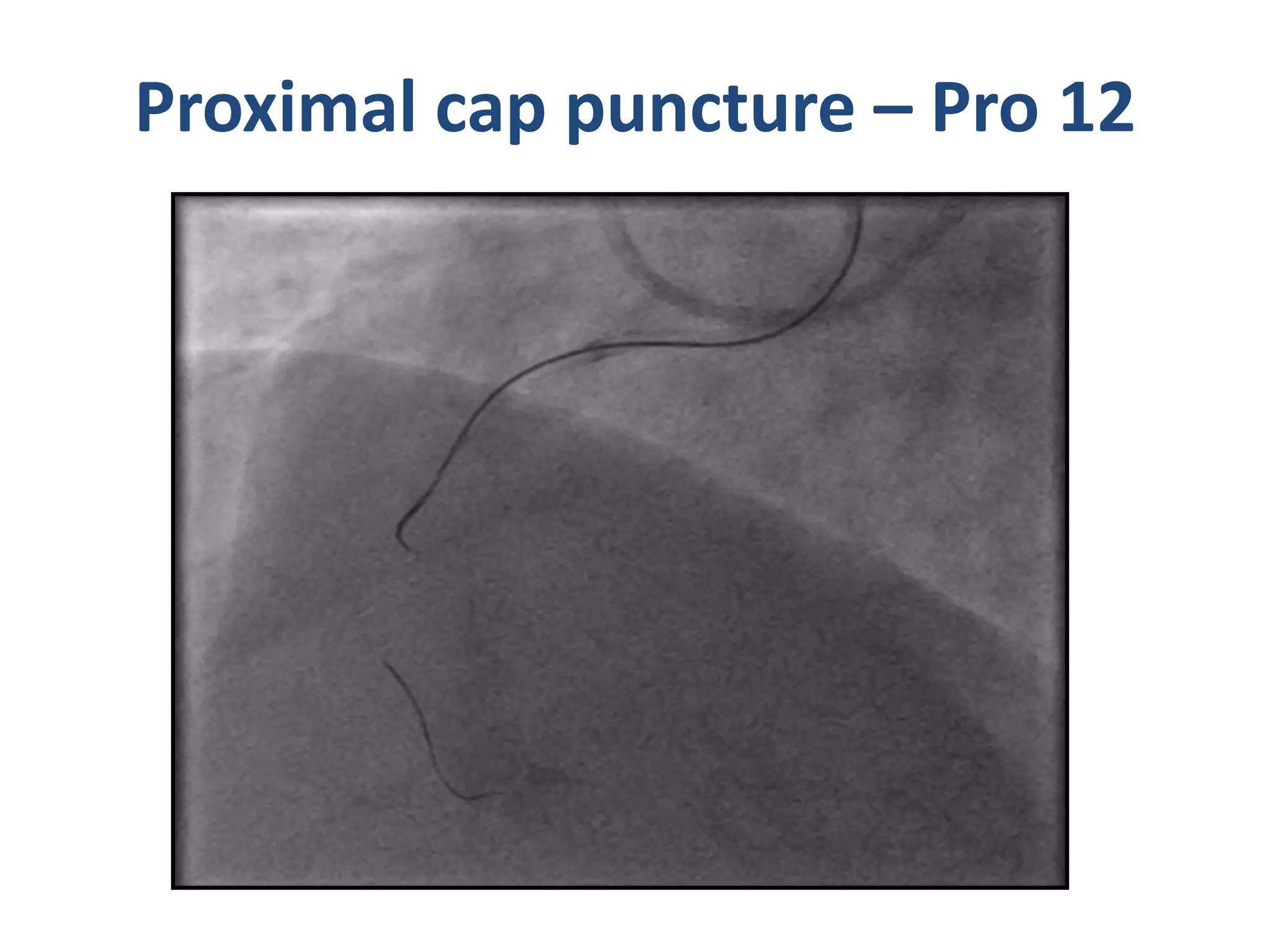 Antegrade dissection and haematoma | PPT