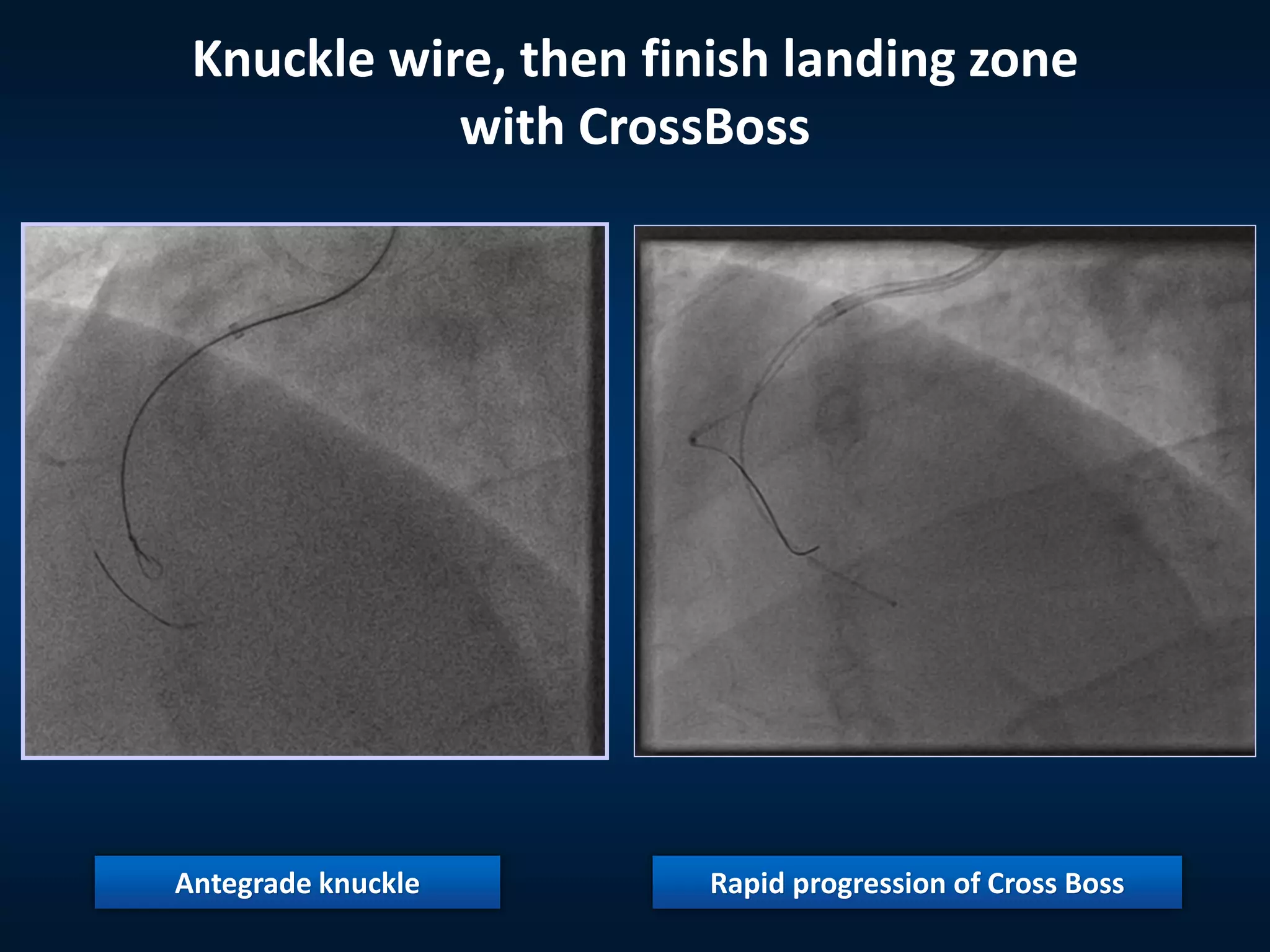 Antegrade dissection and haematoma | PPT