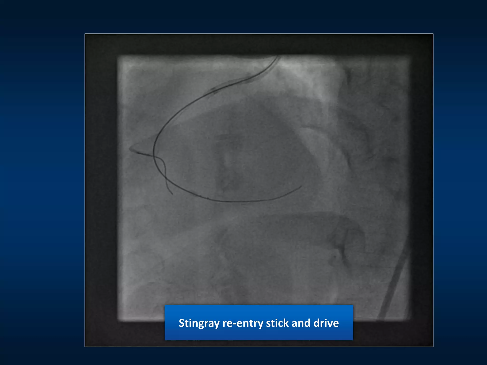 Antegrade dissection and haematoma | PPT