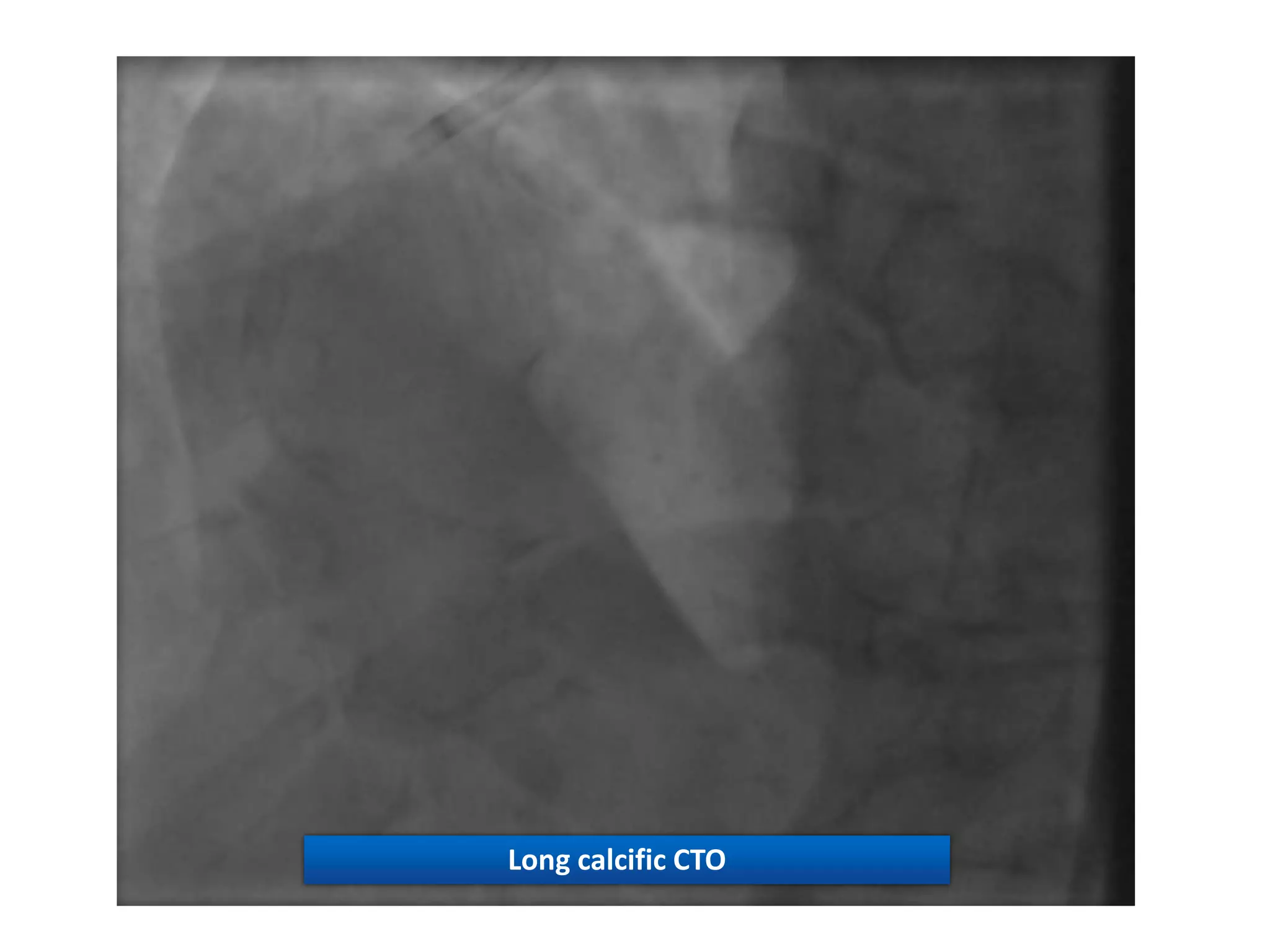 Antegrade dissection and haematoma | PPT