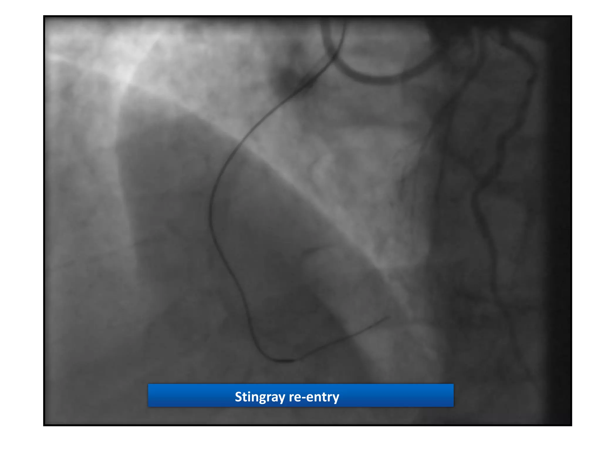 Antegrade dissection and haematoma | PPT