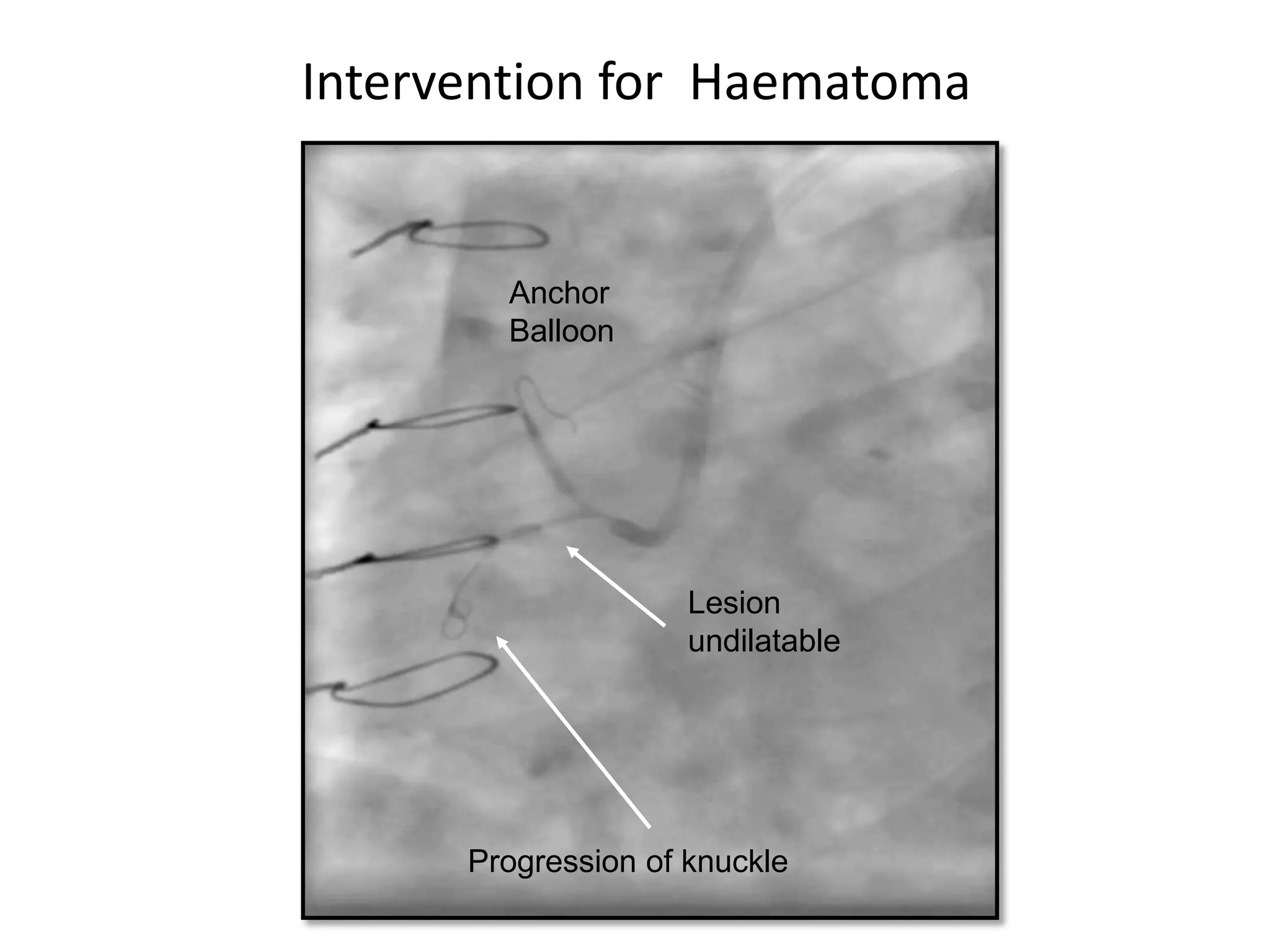 Antegrade dissection and haematoma | PPT