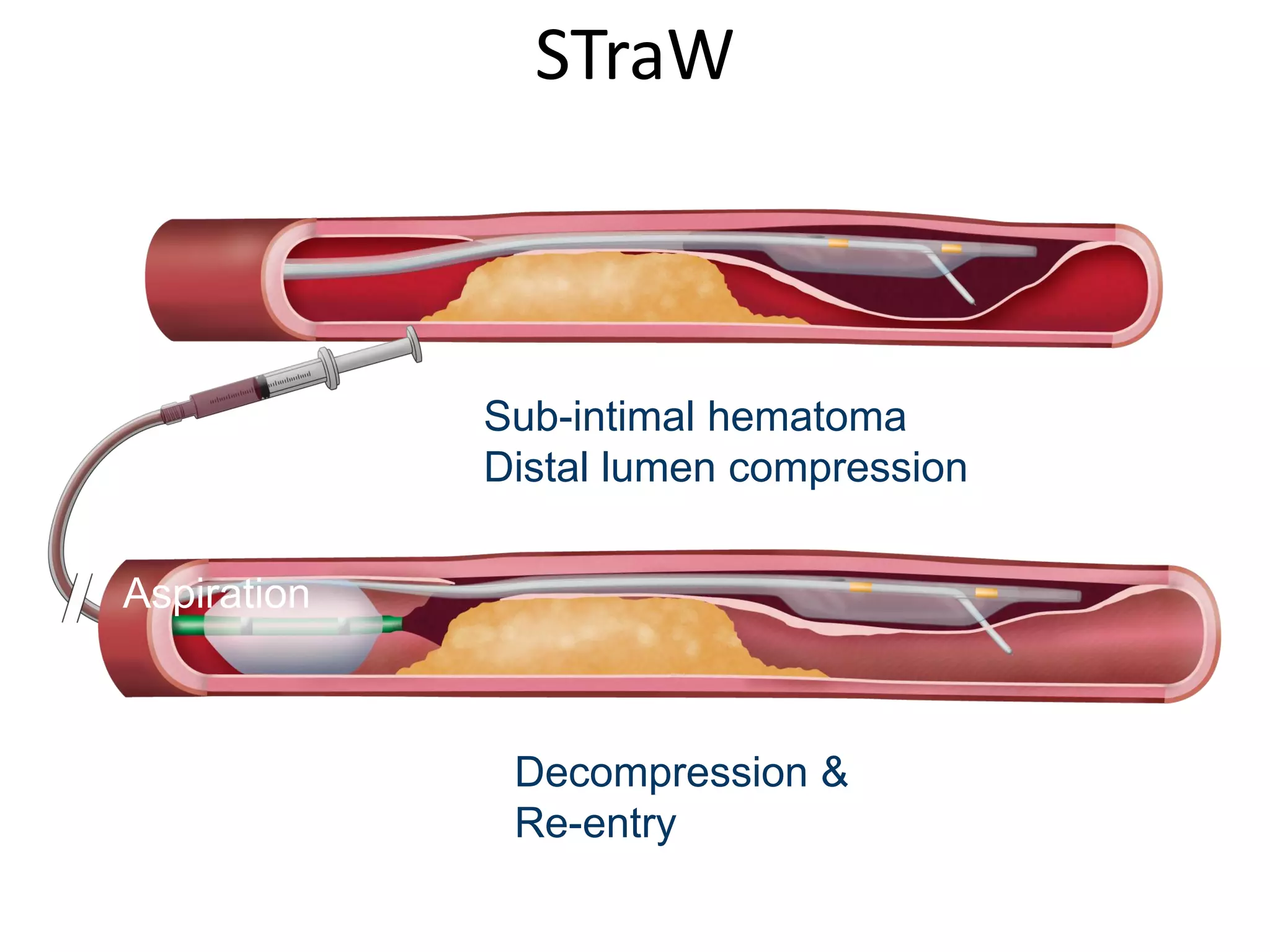 Antegrade dissection and haematoma | PPT